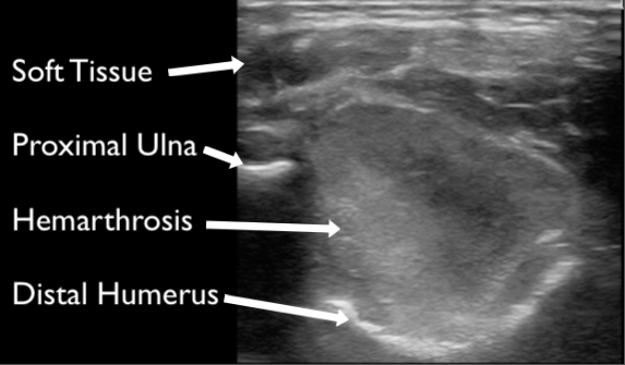 MSK #POCUS 2nd Installment muscles, tendons and bones oh my #foamed # ...