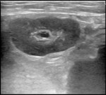 #POCUS for Soft Tissue. Cellulitis, abscess, nec fasc. #foamed #foamus ...