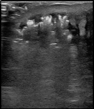 #POCUS for Soft Tissue. Cellulitis, abscess, nec fasc. #foamed #foamus ...