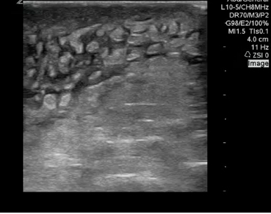 #POCUS for Soft Tissue. Cellulitis, abscess, nec fasc. #foamed #foamus ...
