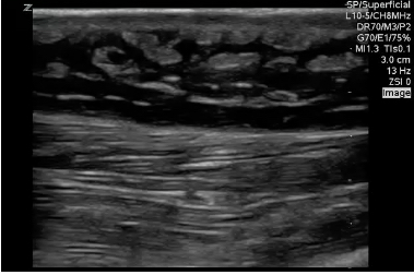 #POCUS for Soft Tissue. Cellulitis, abscess, nec fasc. #foamed #foamus ...