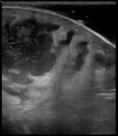 #POCUS for Soft Tissue. Cellulitis, abscess, nec fasc. #foamed #foamus ...