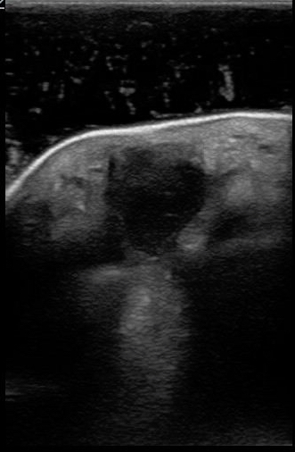 #POCUS for Soft Tissue. Cellulitis, abscess, nec fasc. #foamed #foamus ...
