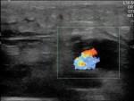 #POCUS for Soft Tissue. Cellulitis, abscess, nec fasc. #foamed #foamus ...
