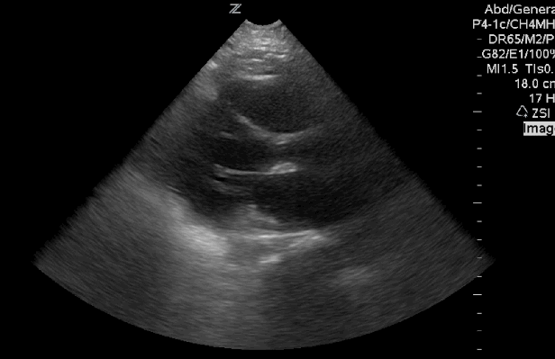 #FOAMus #FOAMcc and #disco all in one for this #Sono of the Week #POCUS ...